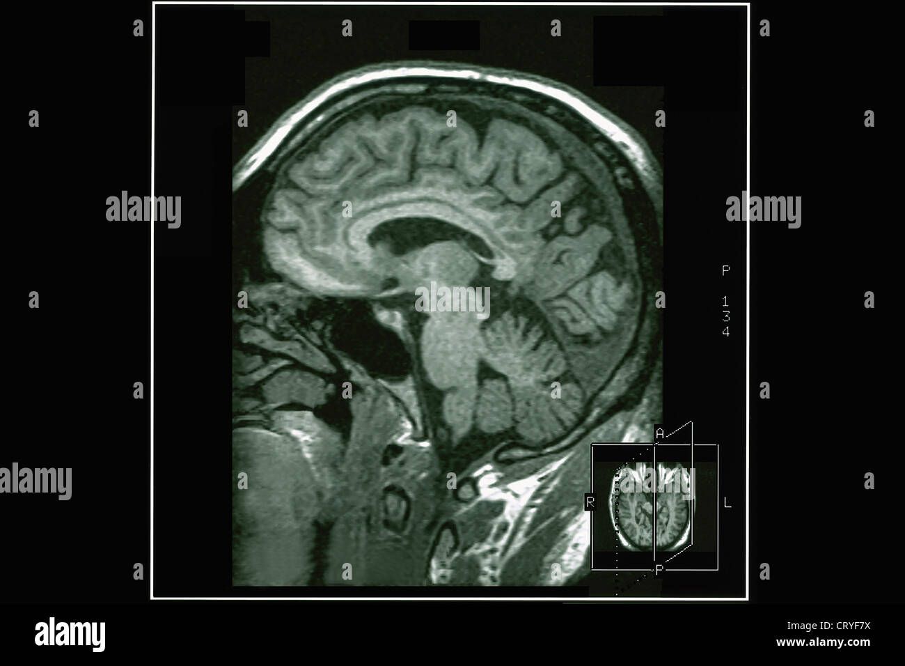 Cingulate gyrus hi-res stock photography and images - Alamy