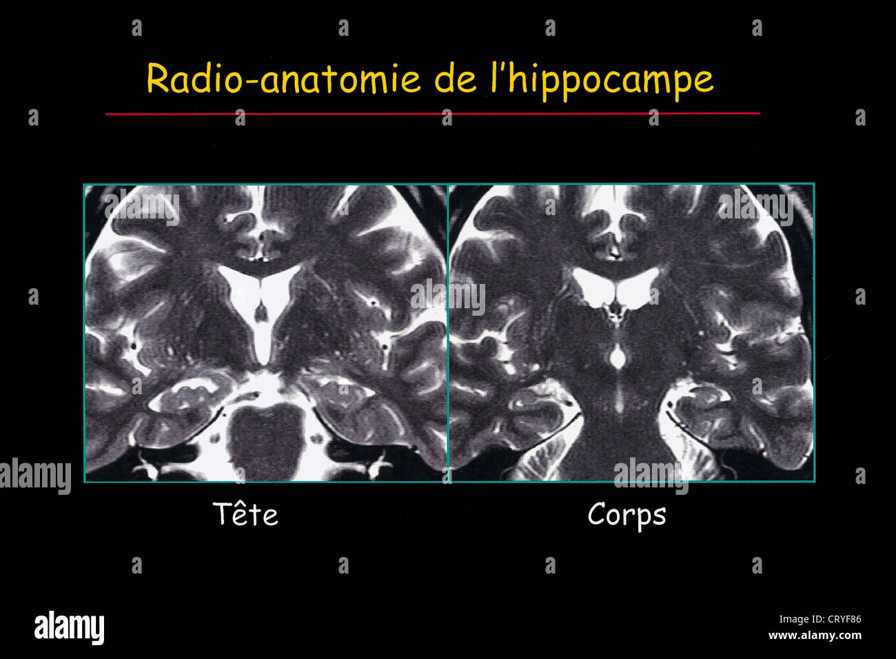 Brain hippocampus mri hi-res stock photography and images - Alamy