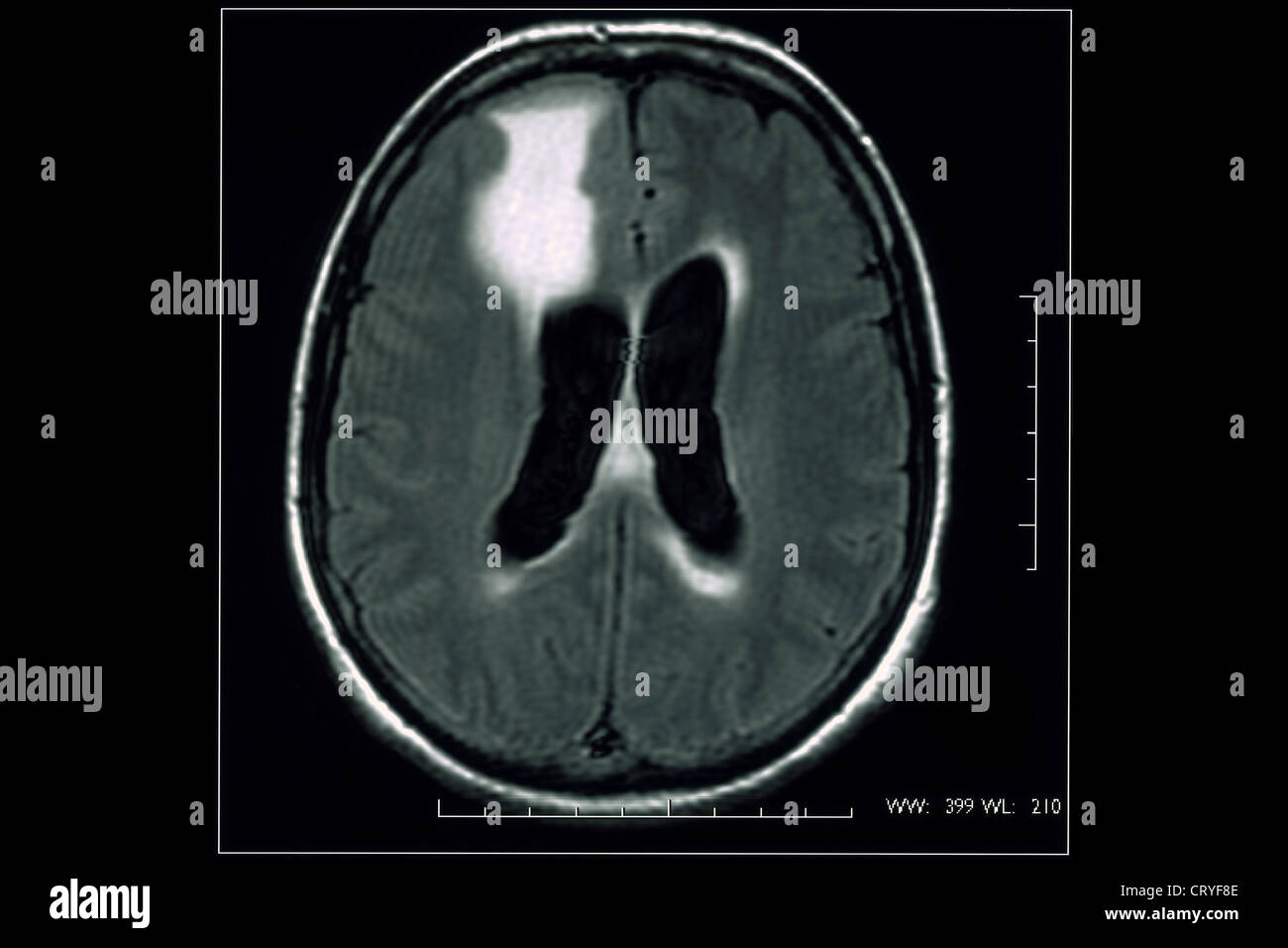 Epilepsy Scan High Resolution Stock Photography and Images - Alamy