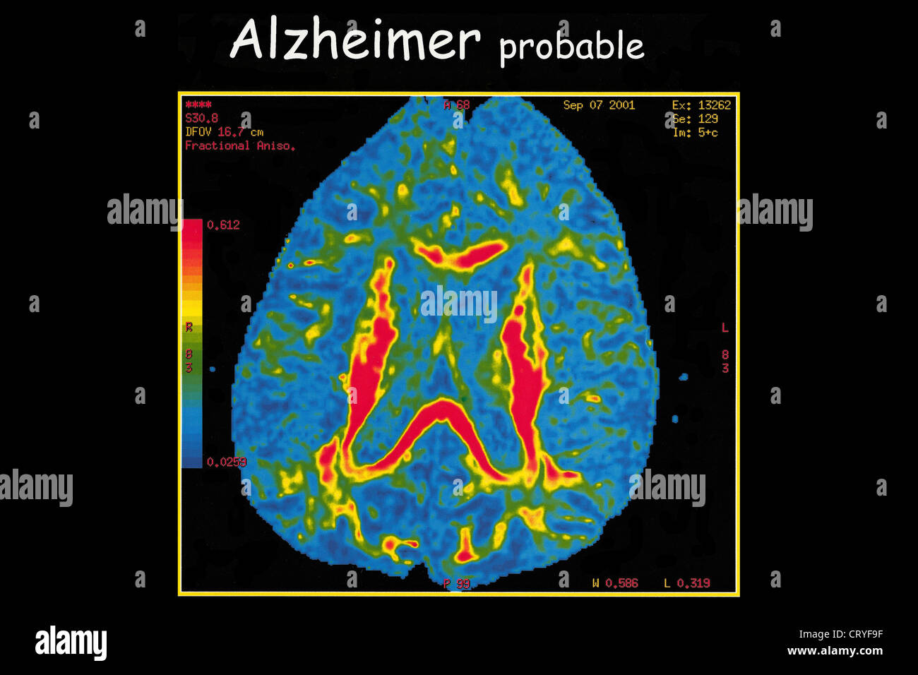 Diffusion mri hi-res stock photography and images - Alamy