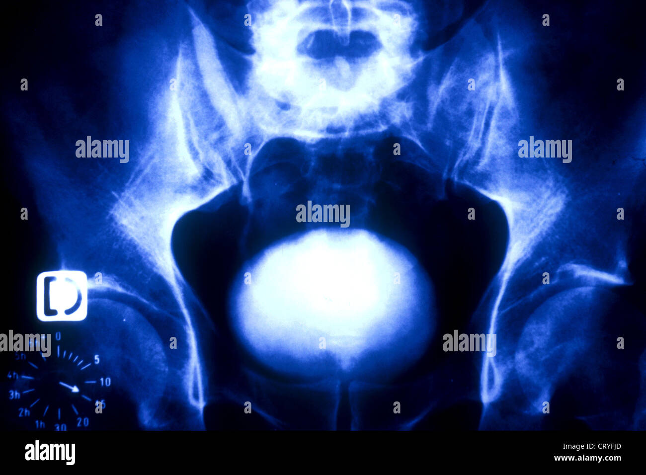 BLADDER, X-RAY RESULT Stock Photo - Alamy
