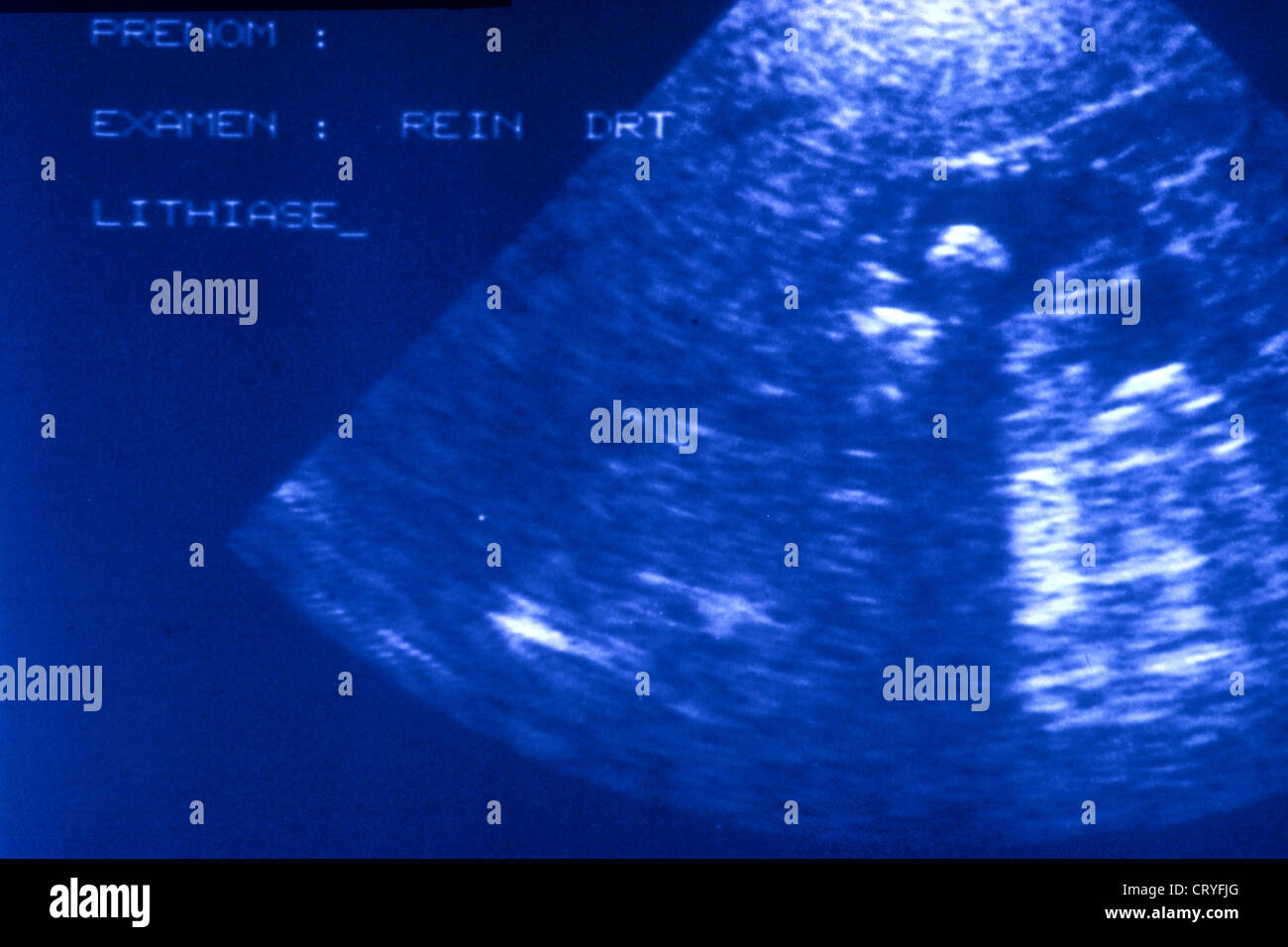 Renal lithiasis ultrasound hi-res stock photography and images - Alamy