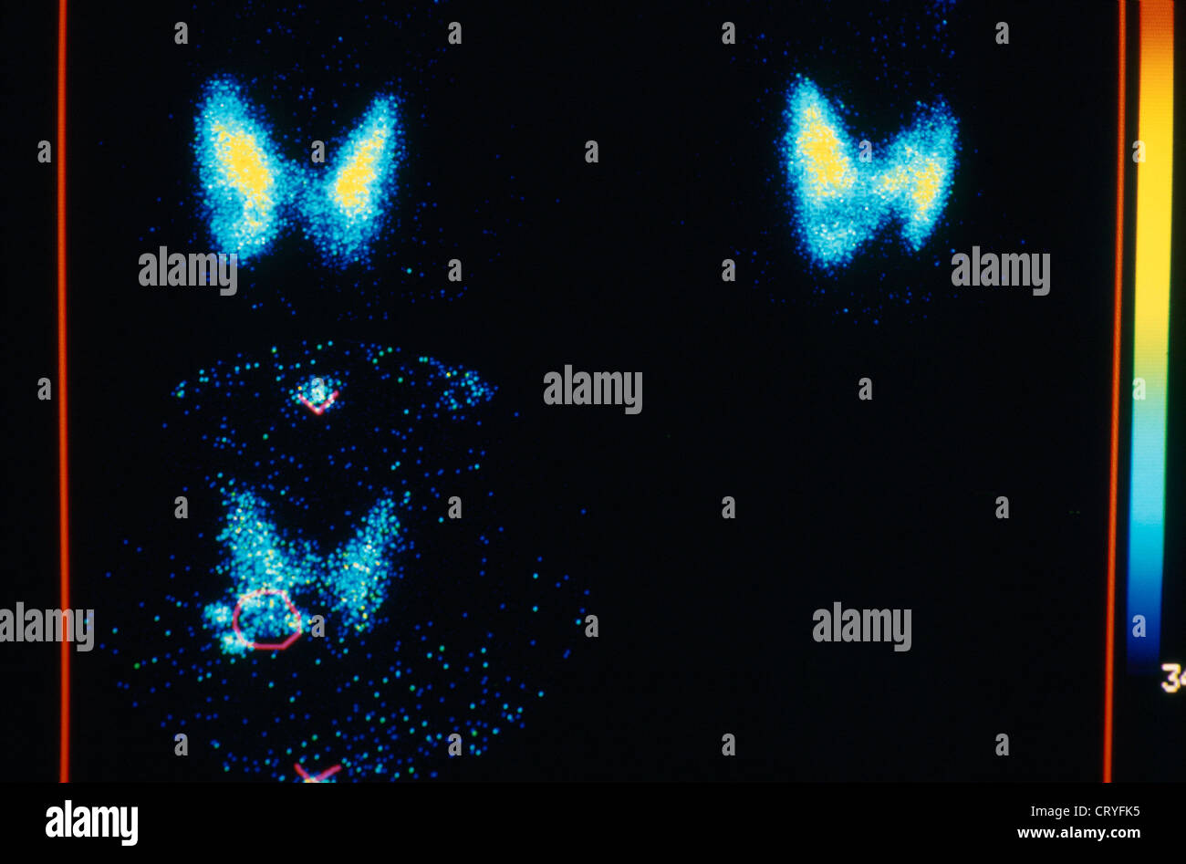 Scintiscanner thyroid hi-res stock photography and images - Alamy