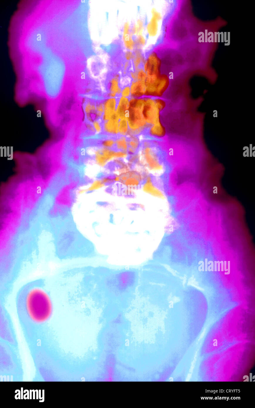 PROSTATIC ADENOMA, X-RAY Stock Photo - Alamy
