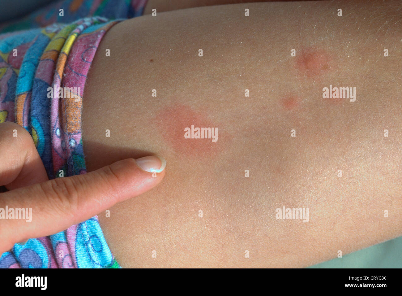 Insect bites child hi-res stock photography and images - Alamy