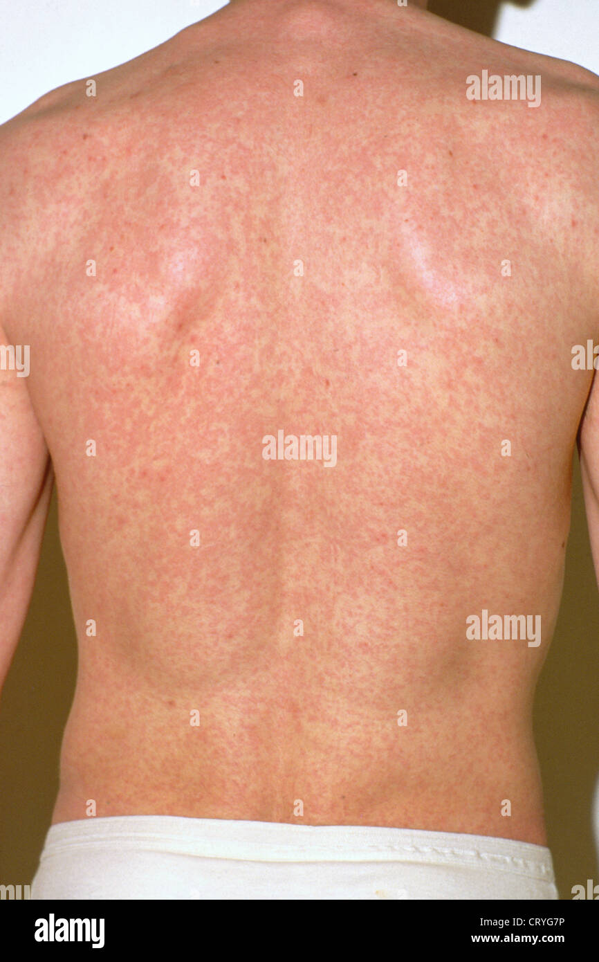 Adults eczema hi-res stock photography and images - Alamy