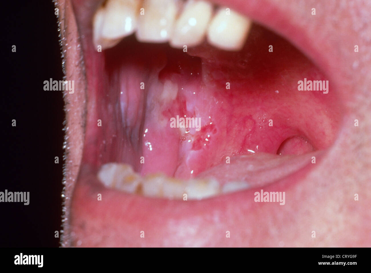Pemphigus hi-res stock photography and images - Alamy