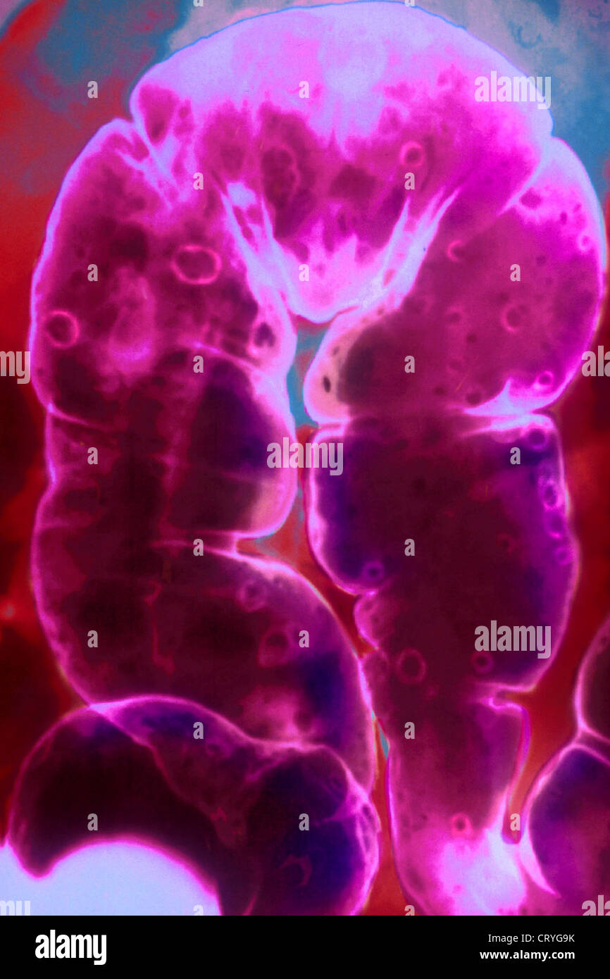 POLYPOSIS OF THE COLON, X-RAY Stock Photo - Alamy