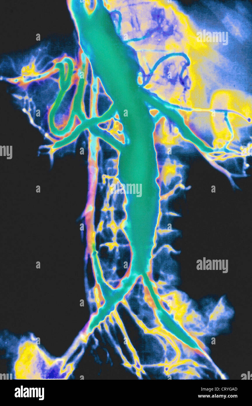 Cholesterol atheroma hi-res stock photography and images - Alamy