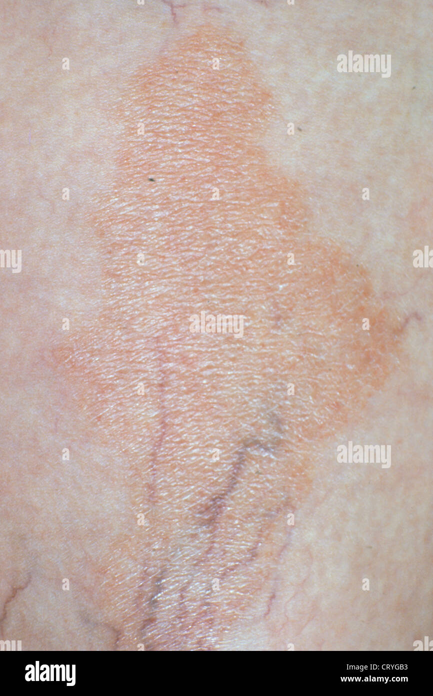 Parapsoriasis hi-res stock photography and images - Alamy