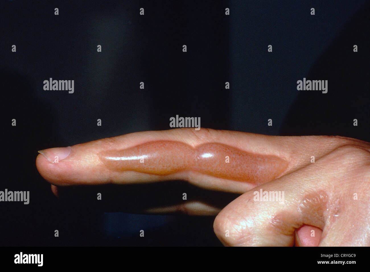 Bullous hi-res stock photography and images - Alamy