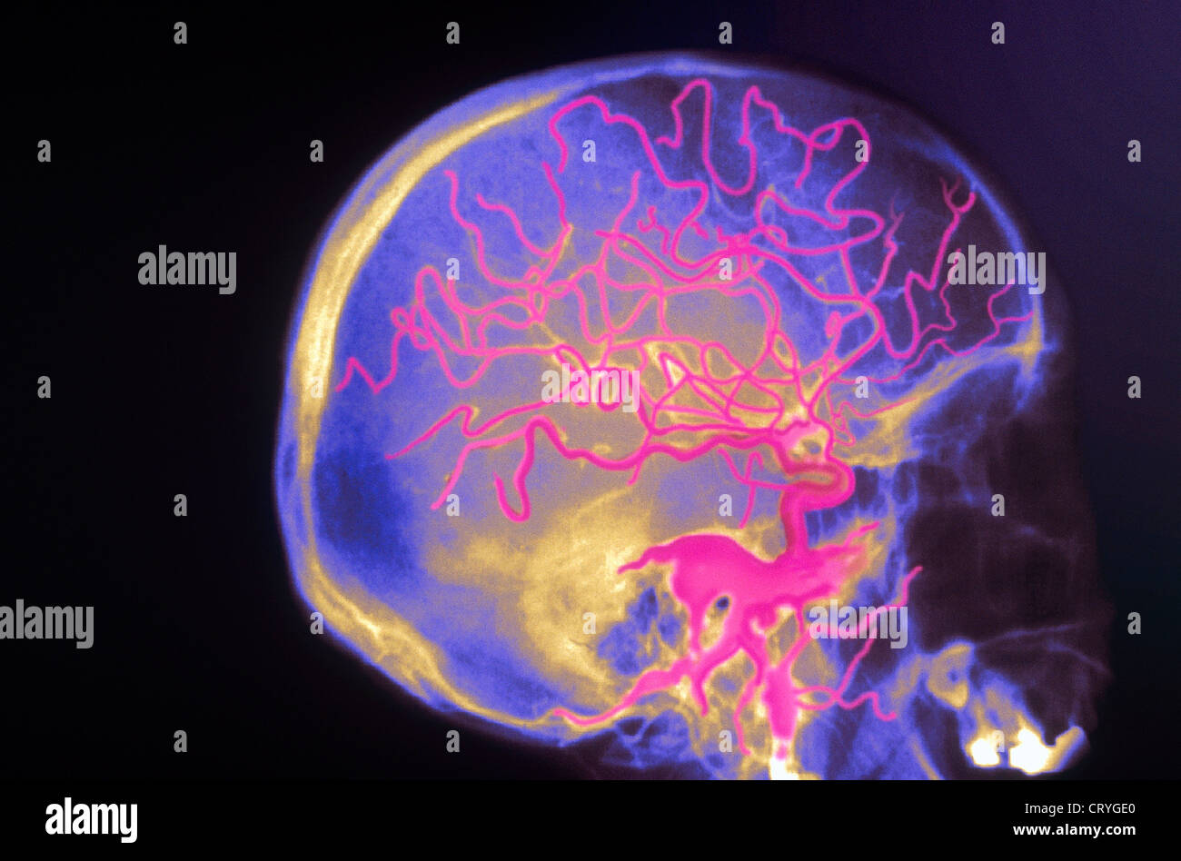 Vascularisation cerebral hi-res stock photography and images - Alamy