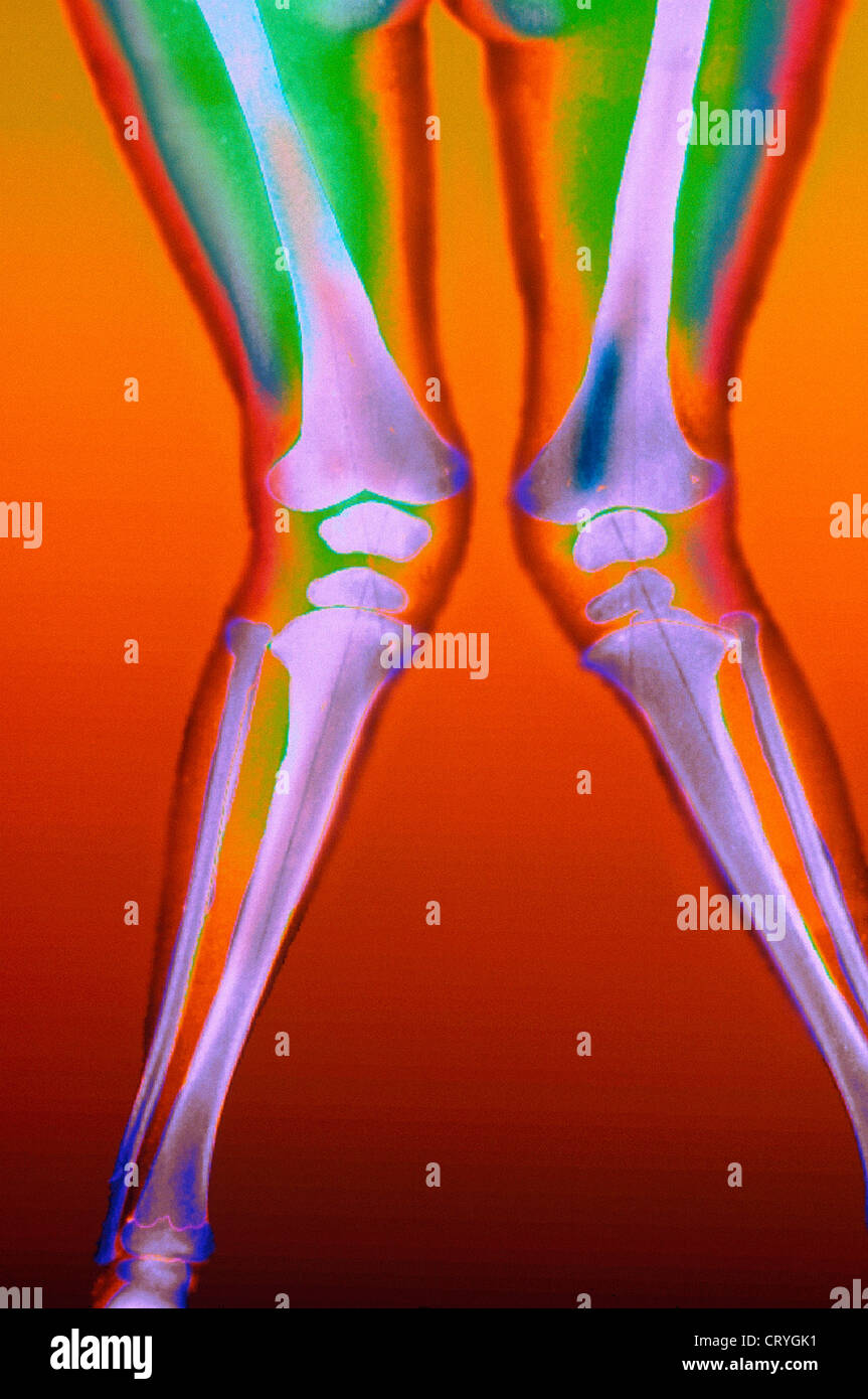 Knock knees hi-res stock photography and images - Alamy