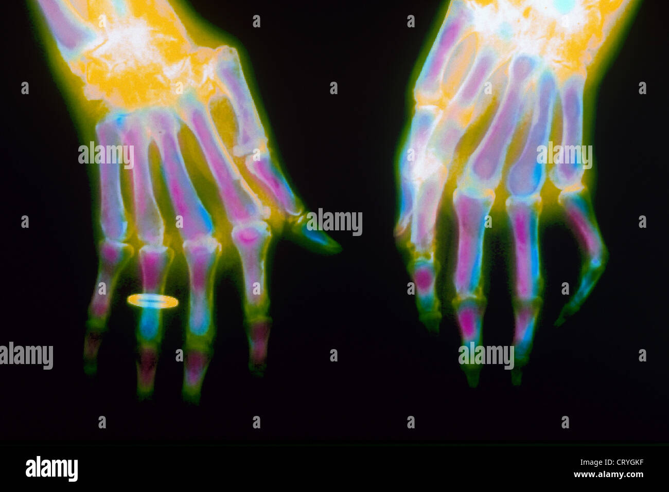 Rheumatoid arthritis hands x ray hi-res stock photography and images ...
