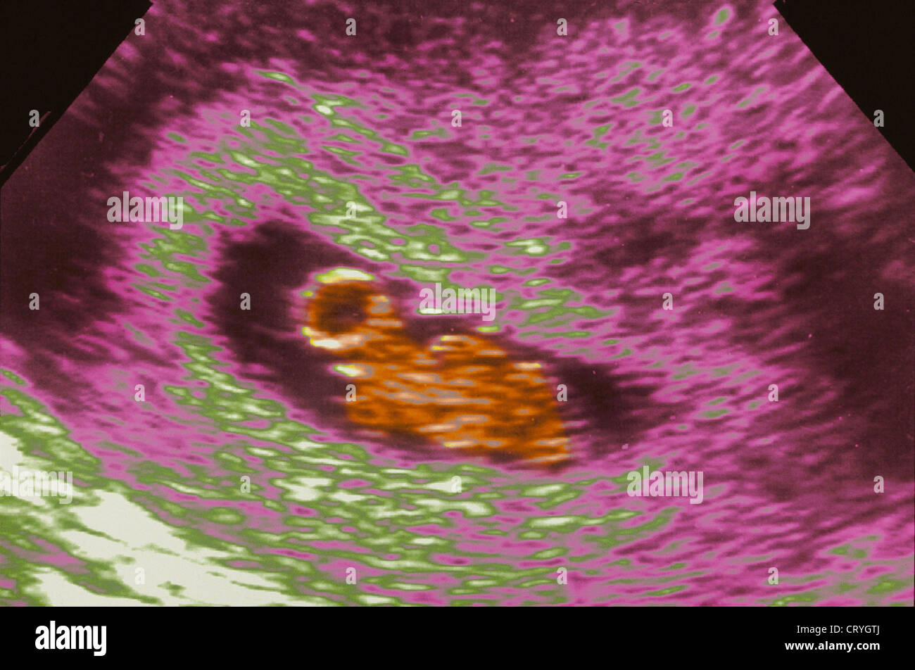 EMBRYO, ULTRASOUND BIOMETRY Stock Photo - Alamy