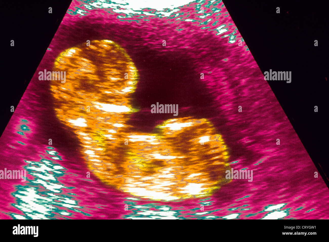 ULTRASOUND BIOMETRY OF THE FETUS Stock Photo - Alamy