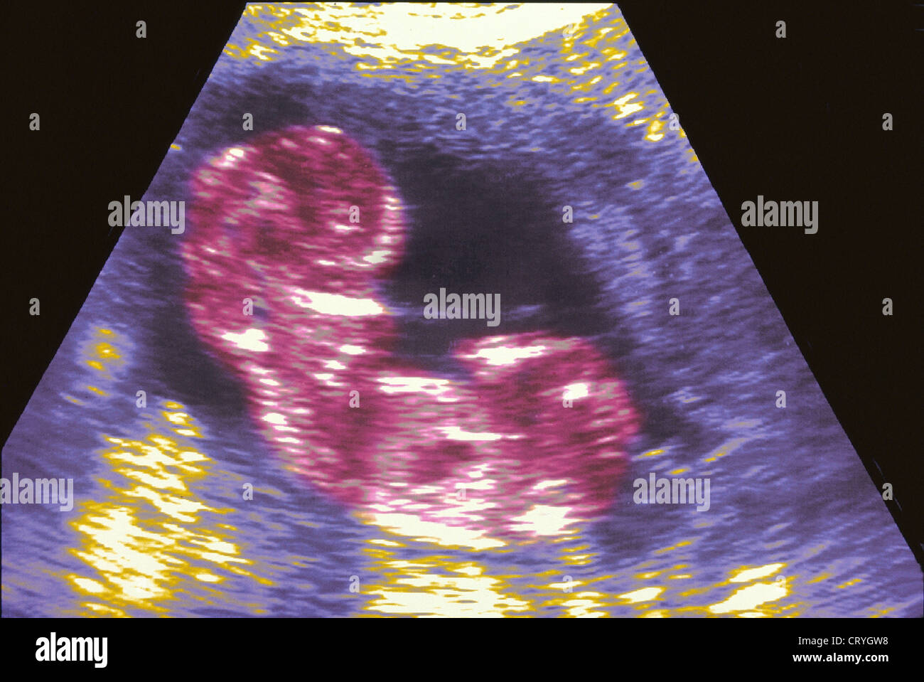 4 months fetus hi-res stock photography and images - Alamy