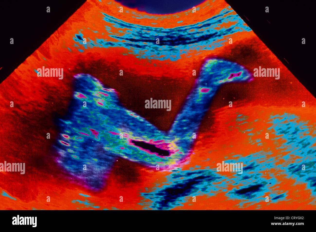 ULTRASOUND BIOMETRY OF THE FETUS Stock Photo - Alamy