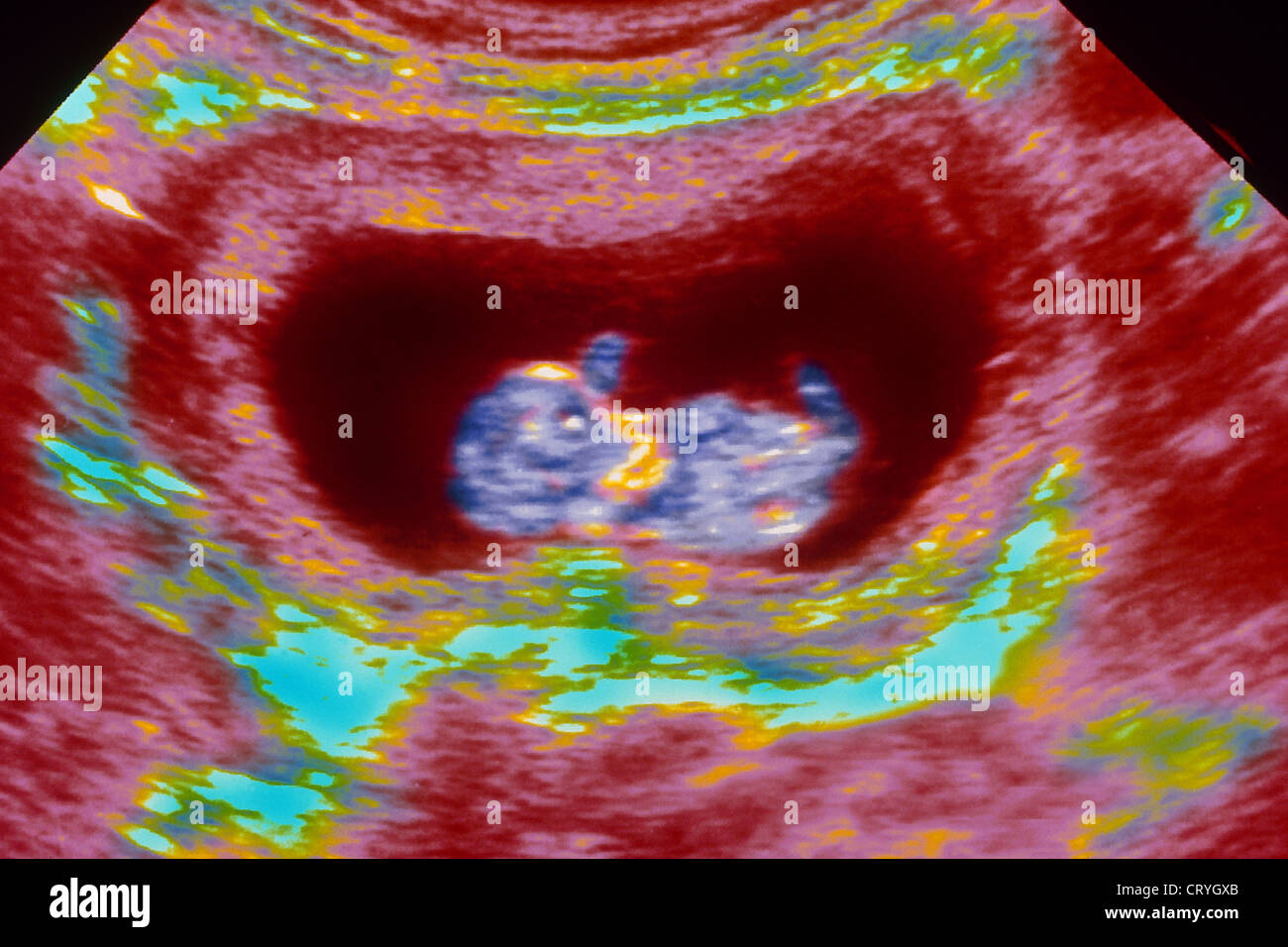 Fetal ultrasound scans hi-res stock photography and images - Alamy