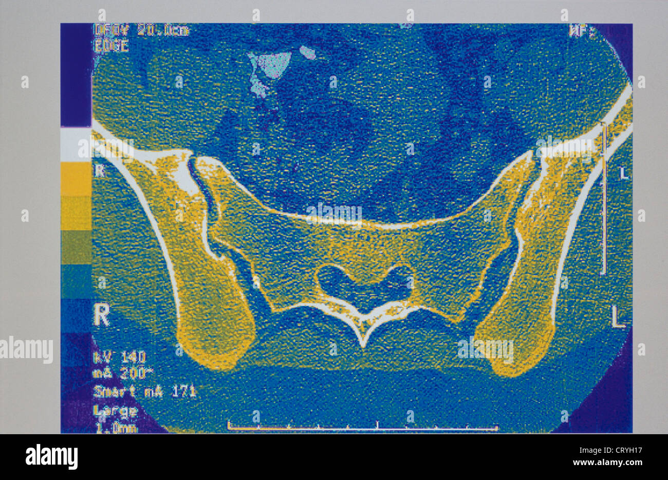 Osteitis hi-res stock photography and images - Alamy