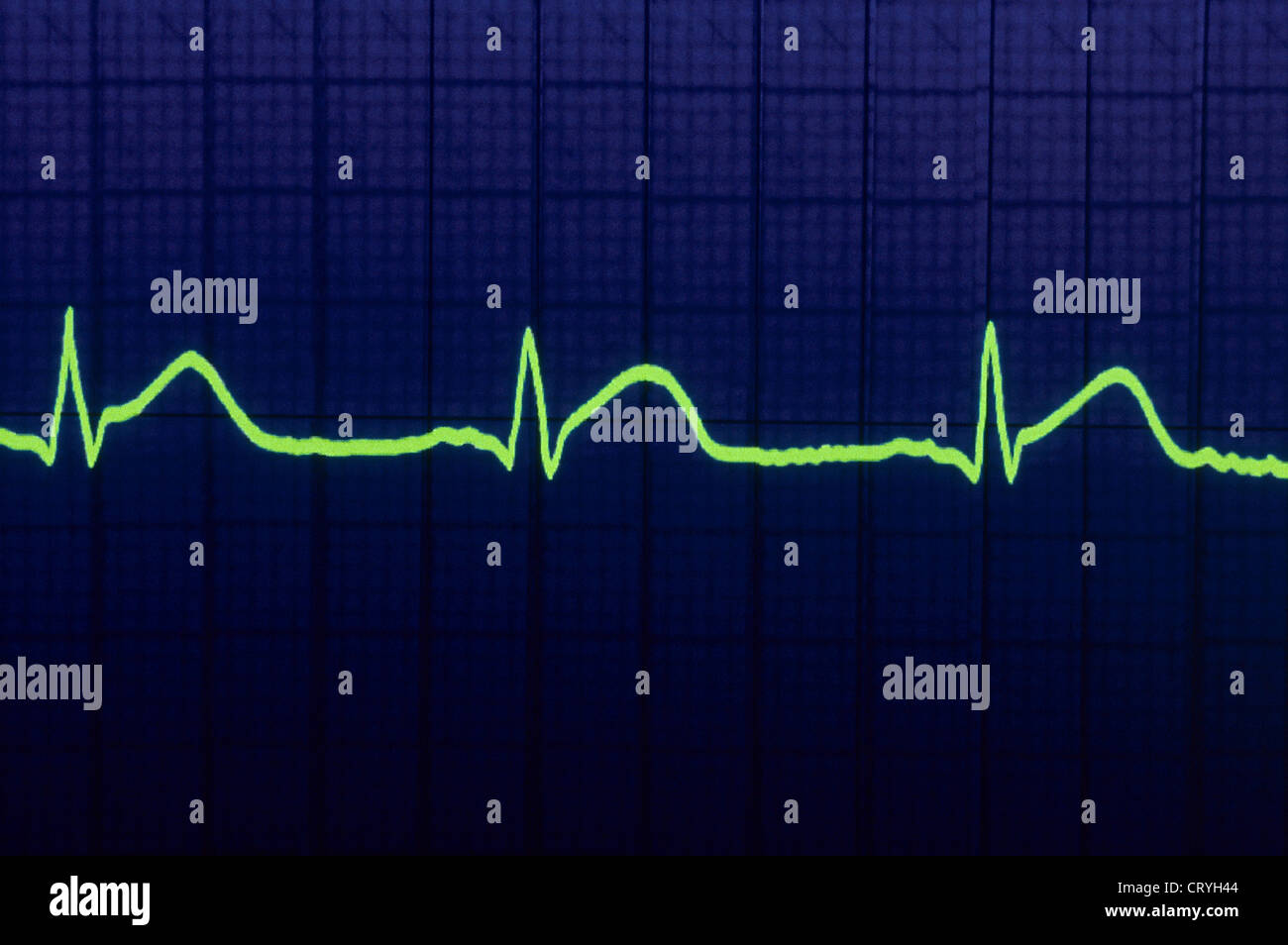 Heart Attack Ecg