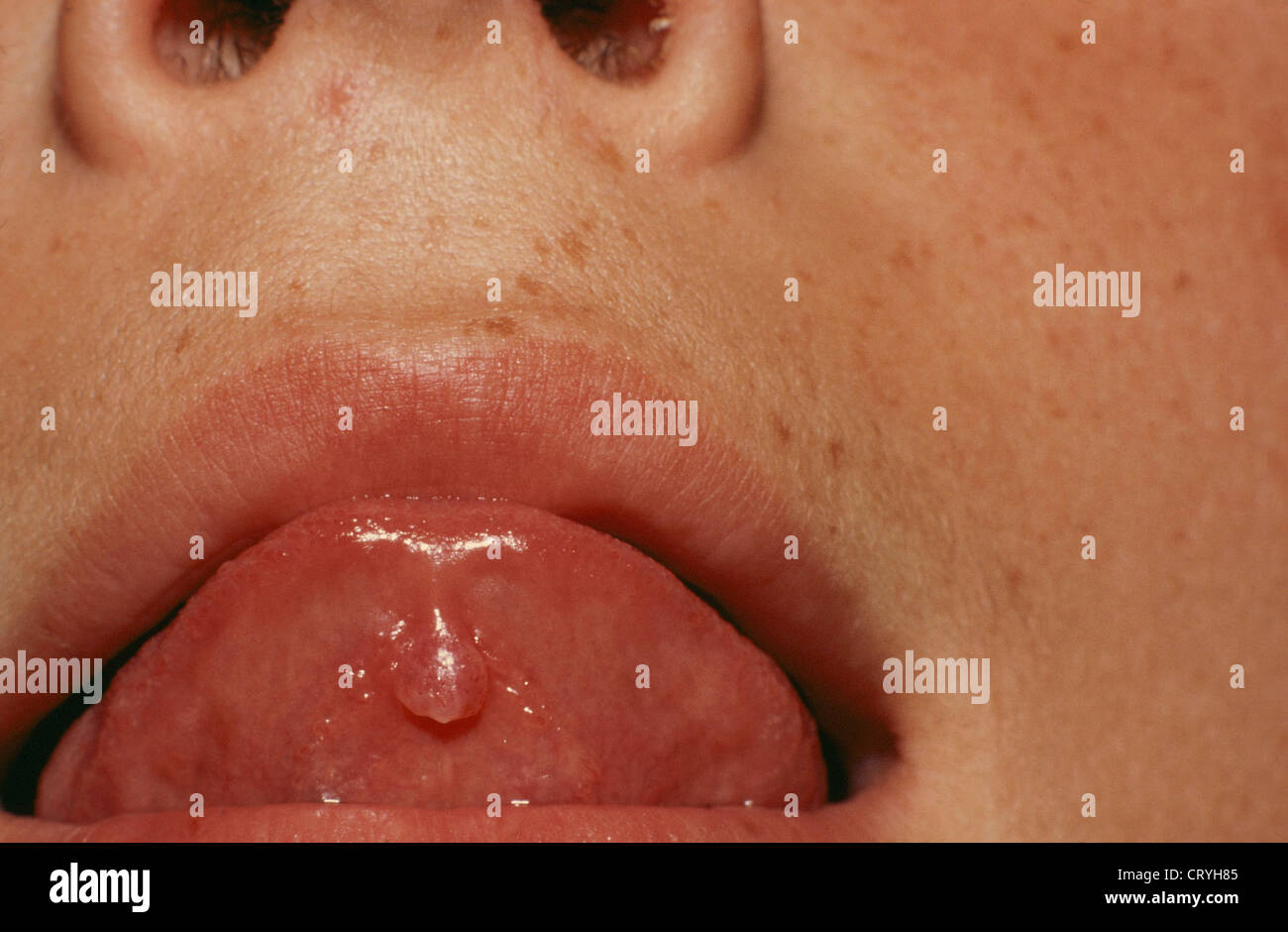 Lymphangioma hi-res stock photography and images - Alamy