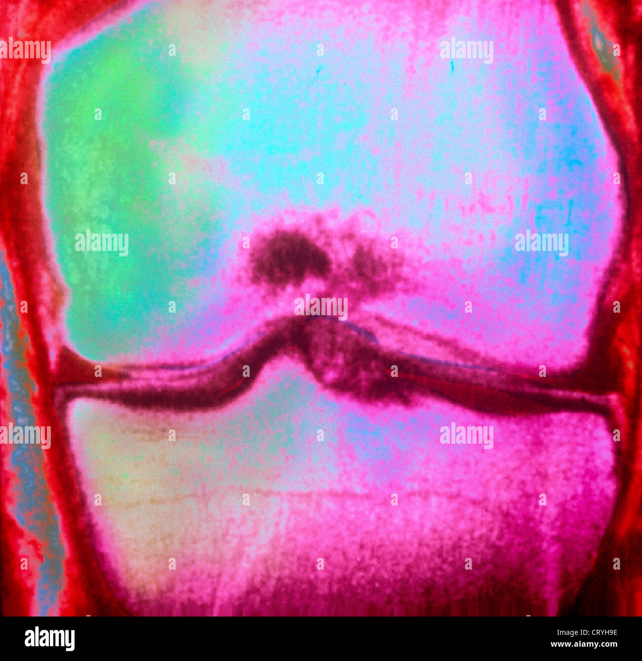 Mri knee normal hi-res stock photography and images - Alamy