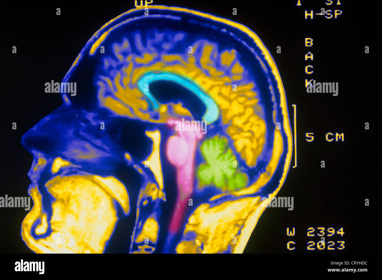 Corpus callosum hemispheres hi-res stock photography and images - Alamy