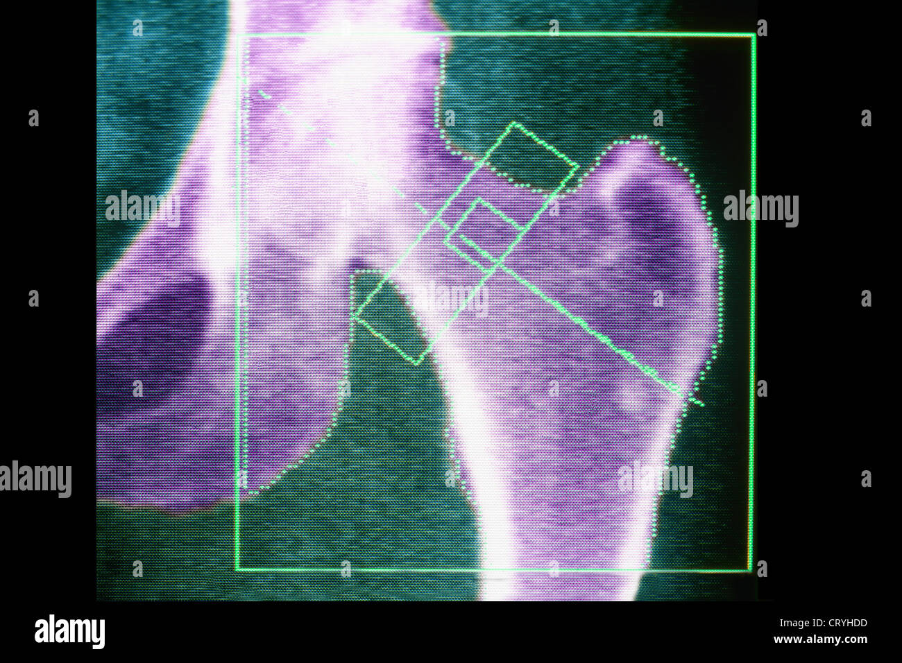 BONE DENSITOMETRY RESULT Stock Photo - Alamy