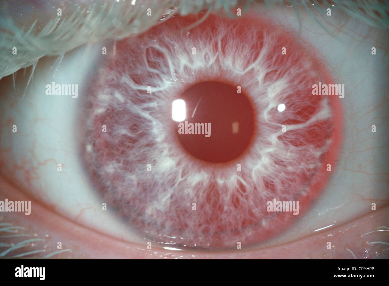 Ocular albinism hi-res stock photography and images - Alamy