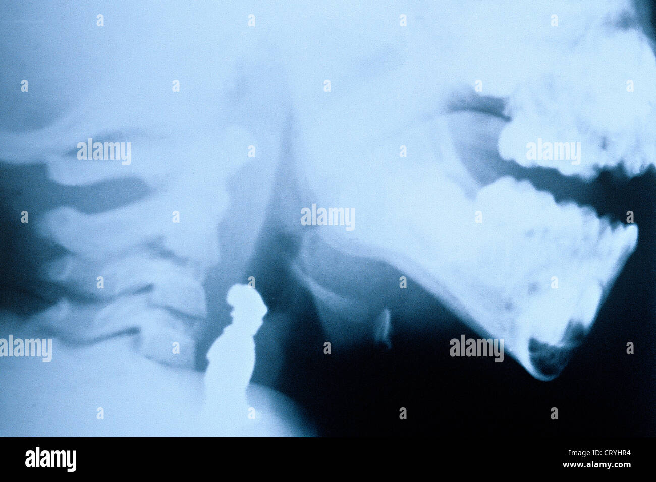 Foreign body throat hi-res stock photography and images - Alamy