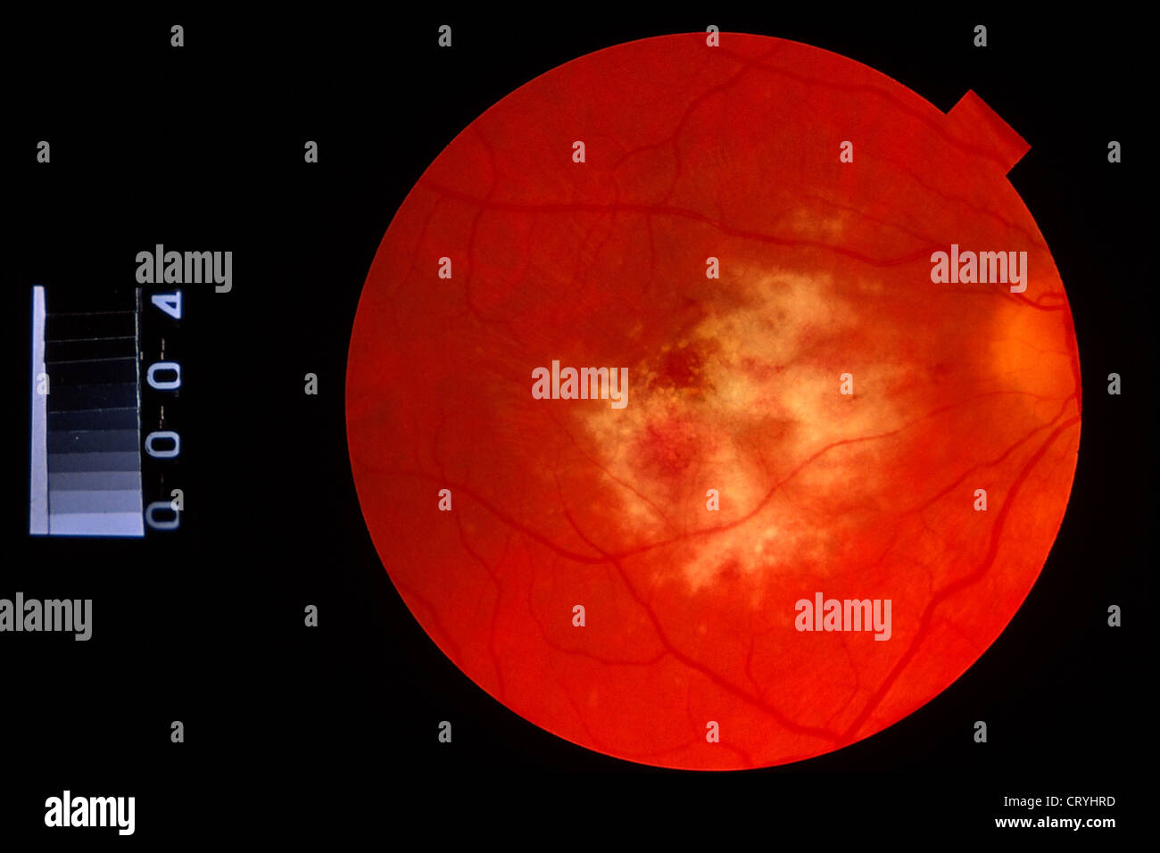 Cmv retinitis hi-res stock photography and images - Alamy