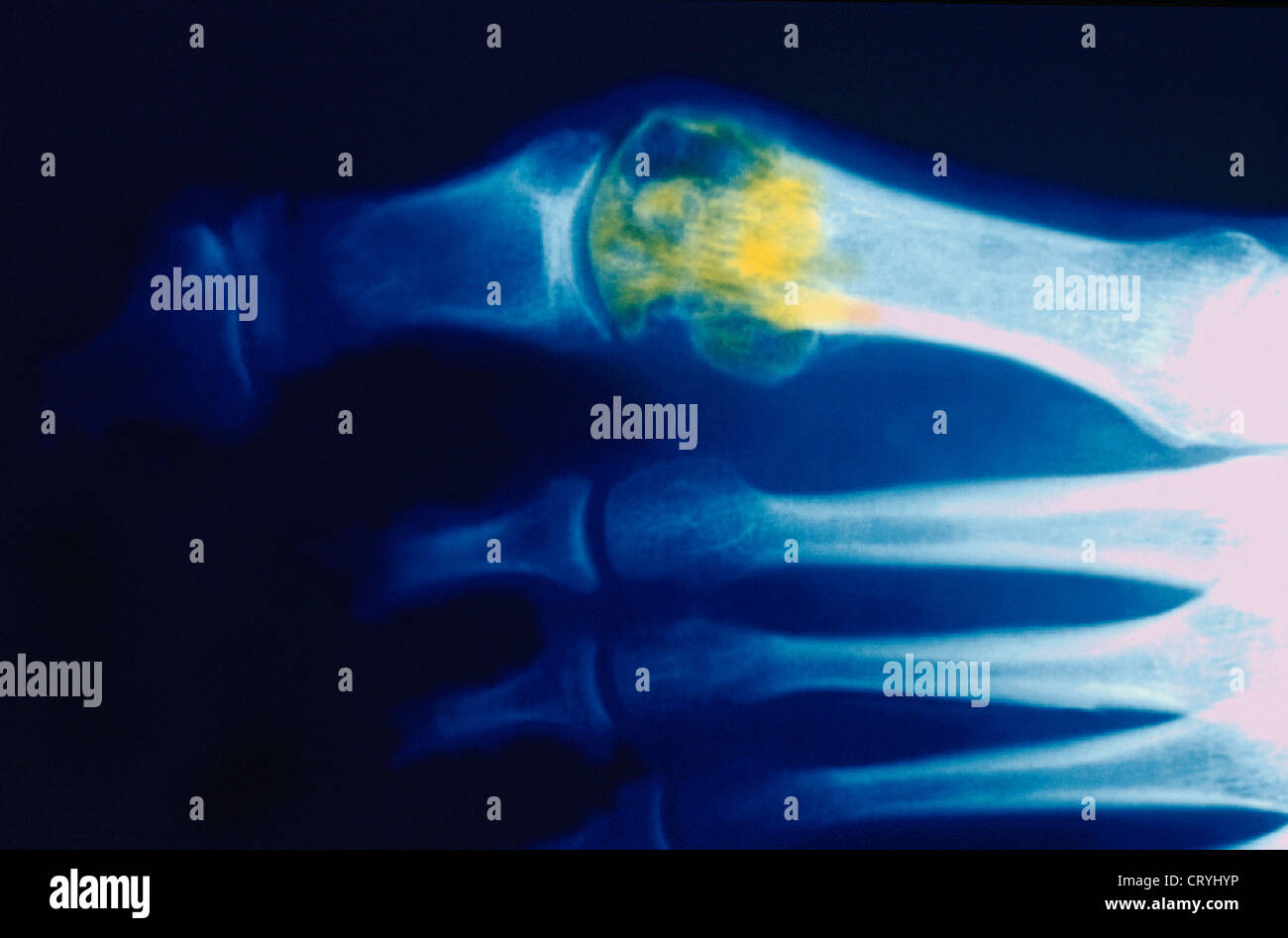 X ray of feet gout hi-res stock photography and images - Alamy