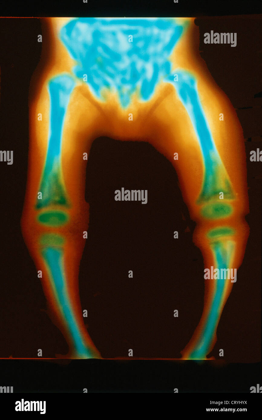 Rickets child hi-res stock photography and images - Alamy