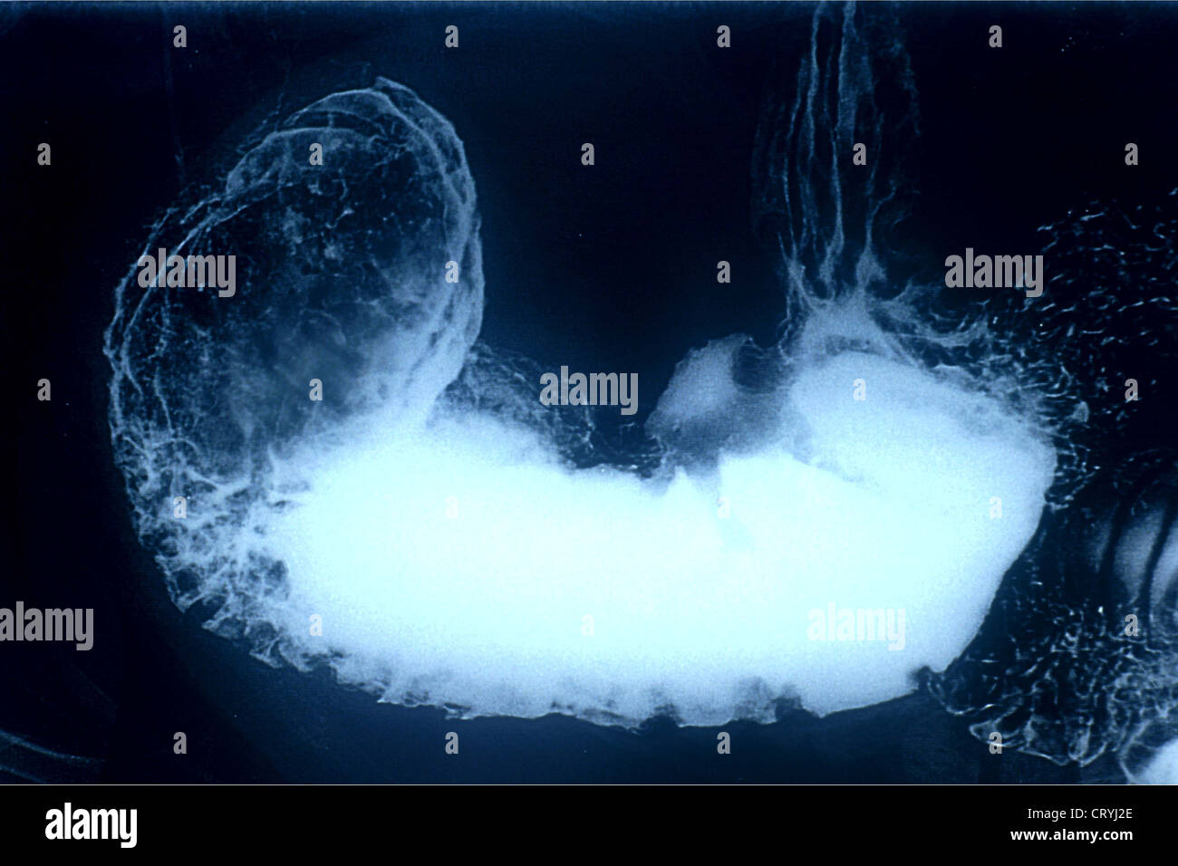 GASTRIC ULCER, X-RAY Stock Photo - Alamy