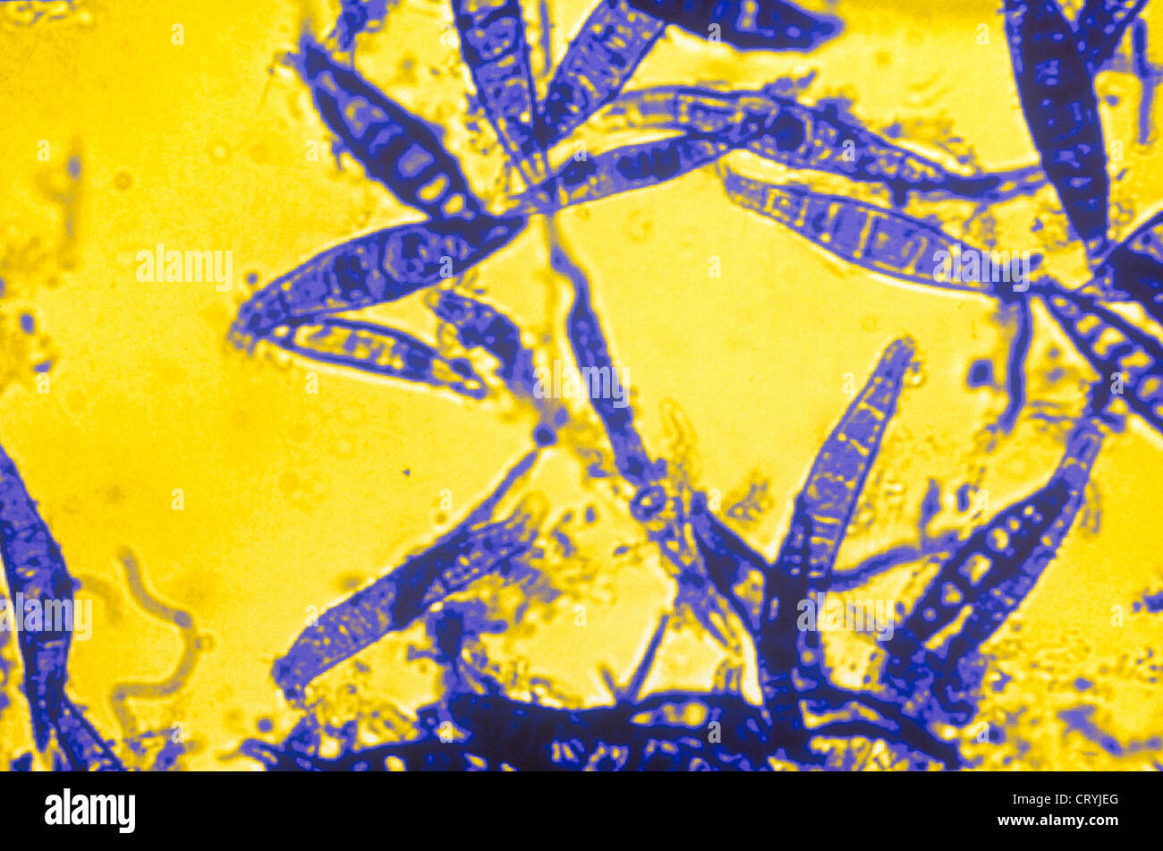 Tinea capitis scalp hi-res stock photography and images - Alamy