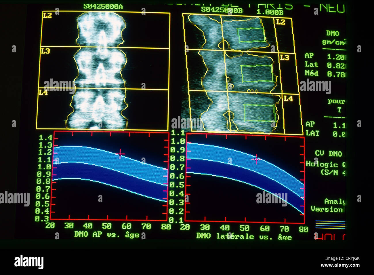 BONE DENSITOMETRY RESULT Stock Photo - Alamy