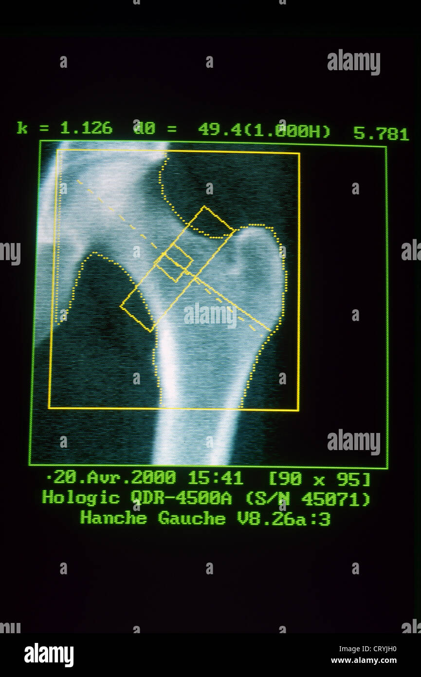 BONE DENSITOMETRY RESULT Stock Photo - Alamy
