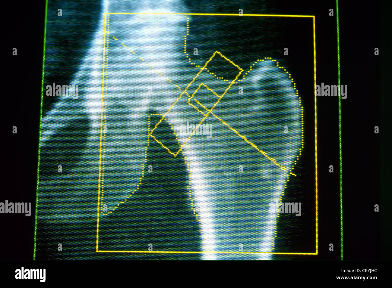 BONE DENSITOMETRY RESULT Stock Photo - Alamy