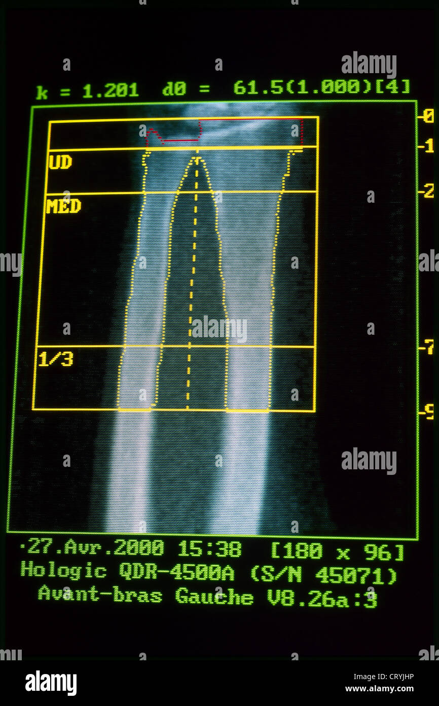 Osteodensimetry hi-res stock photography and images - Alamy