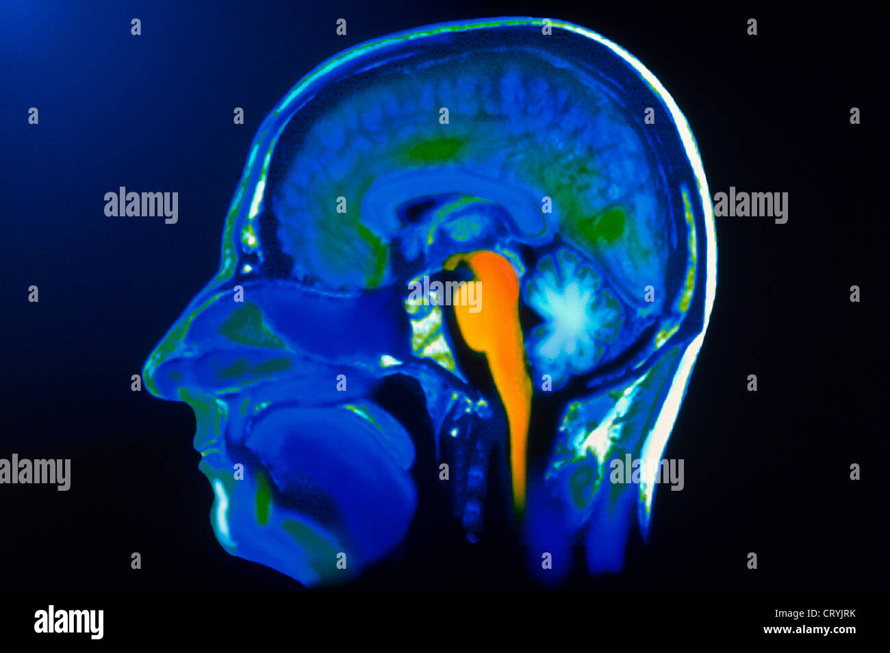 Normal brain mri scan hi-res stock photography and images - Alamy