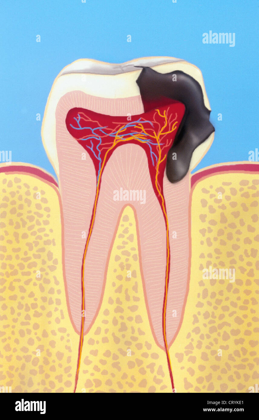 DENTAL CARIE, DRAWING Stock Photo - Alamy