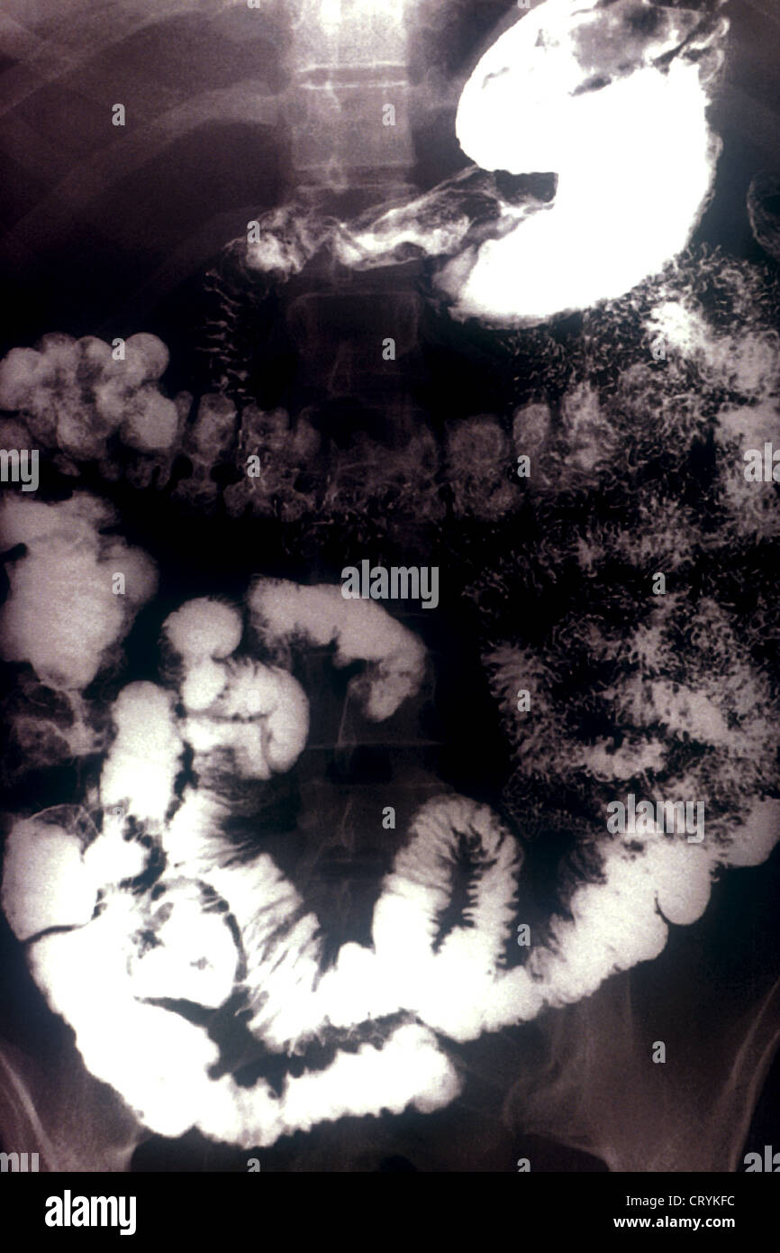 SMALL INTESTINE, X-RAY Stock Photo - Alamy