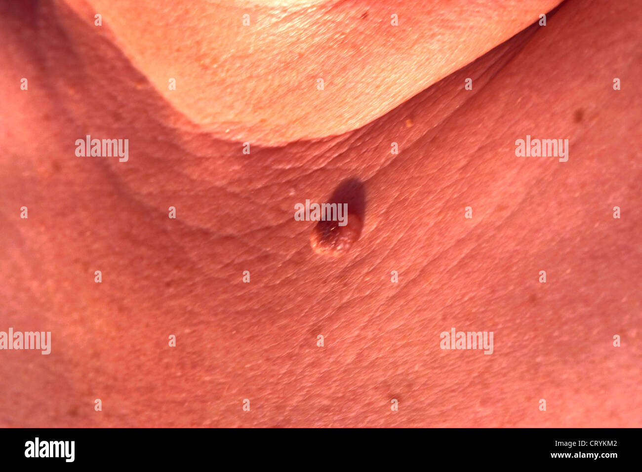 Naevocellular nevus hi-res stock photography and images - Alamy