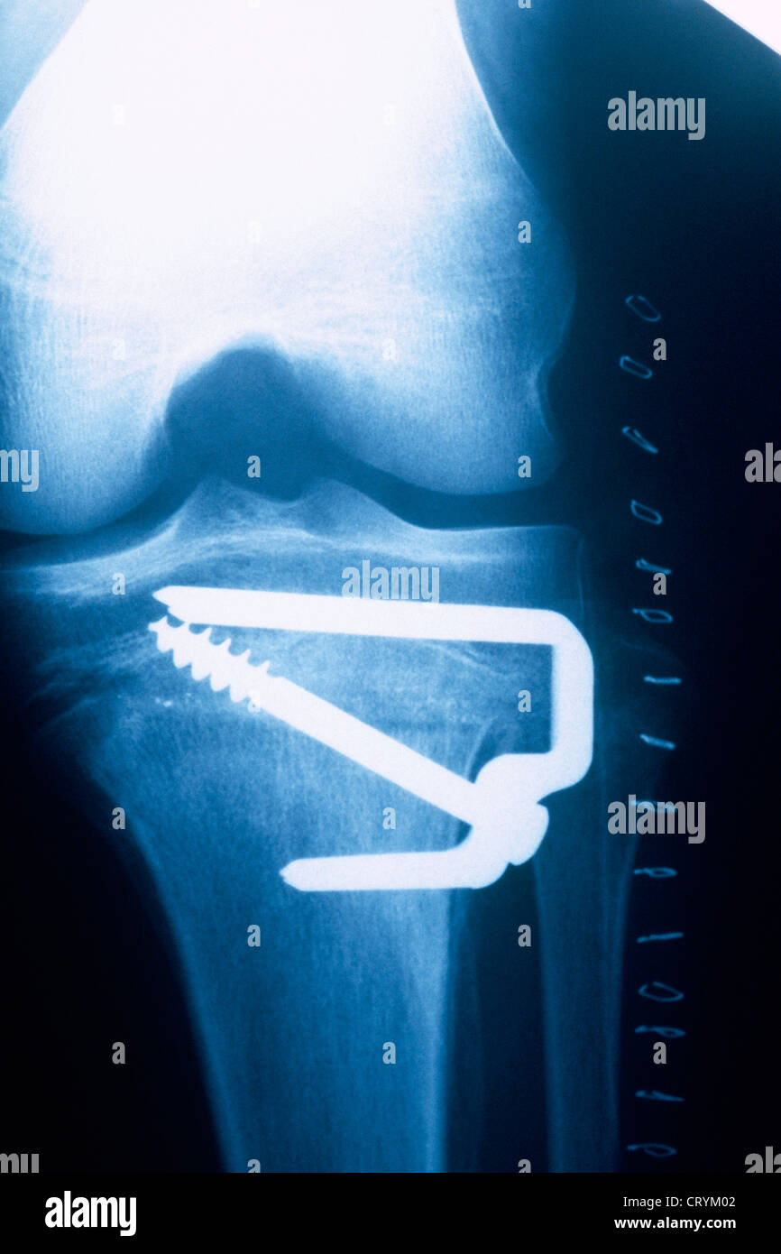 Osteotomy hi-res stock photography and images - Alamy