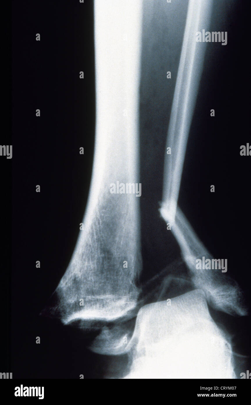 Fractured ankle hi-res stock photography and images - Alamy