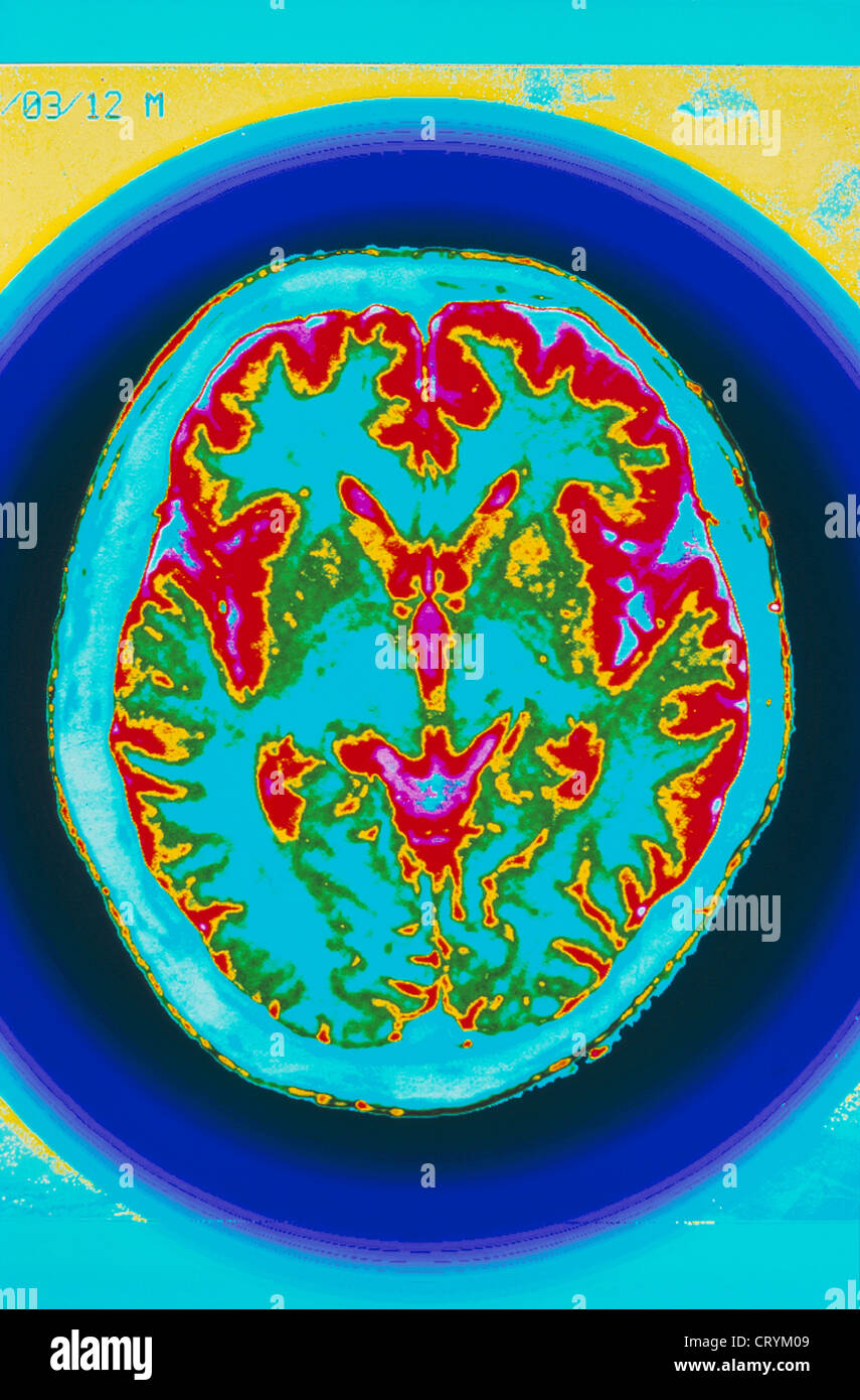 Brain radiogram hi-res stock photography and images - Alamy