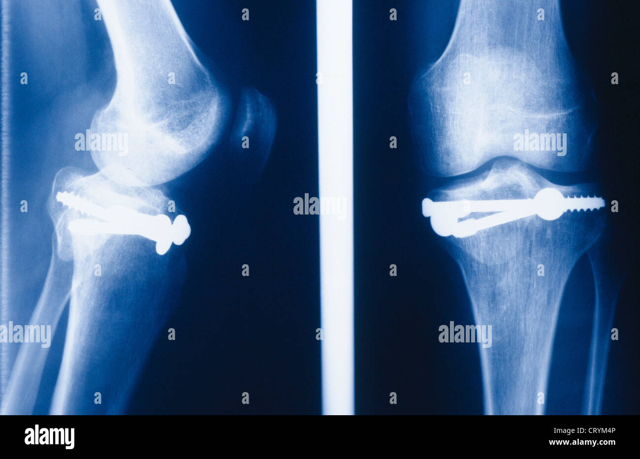Knee surgery photos hi-res stock photography and images - Alamy