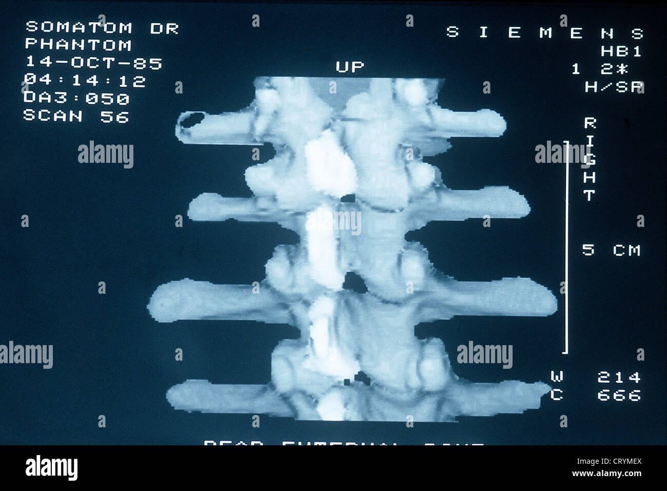 SPINAL COLUMN, SCAN Stock Photo - Alamy