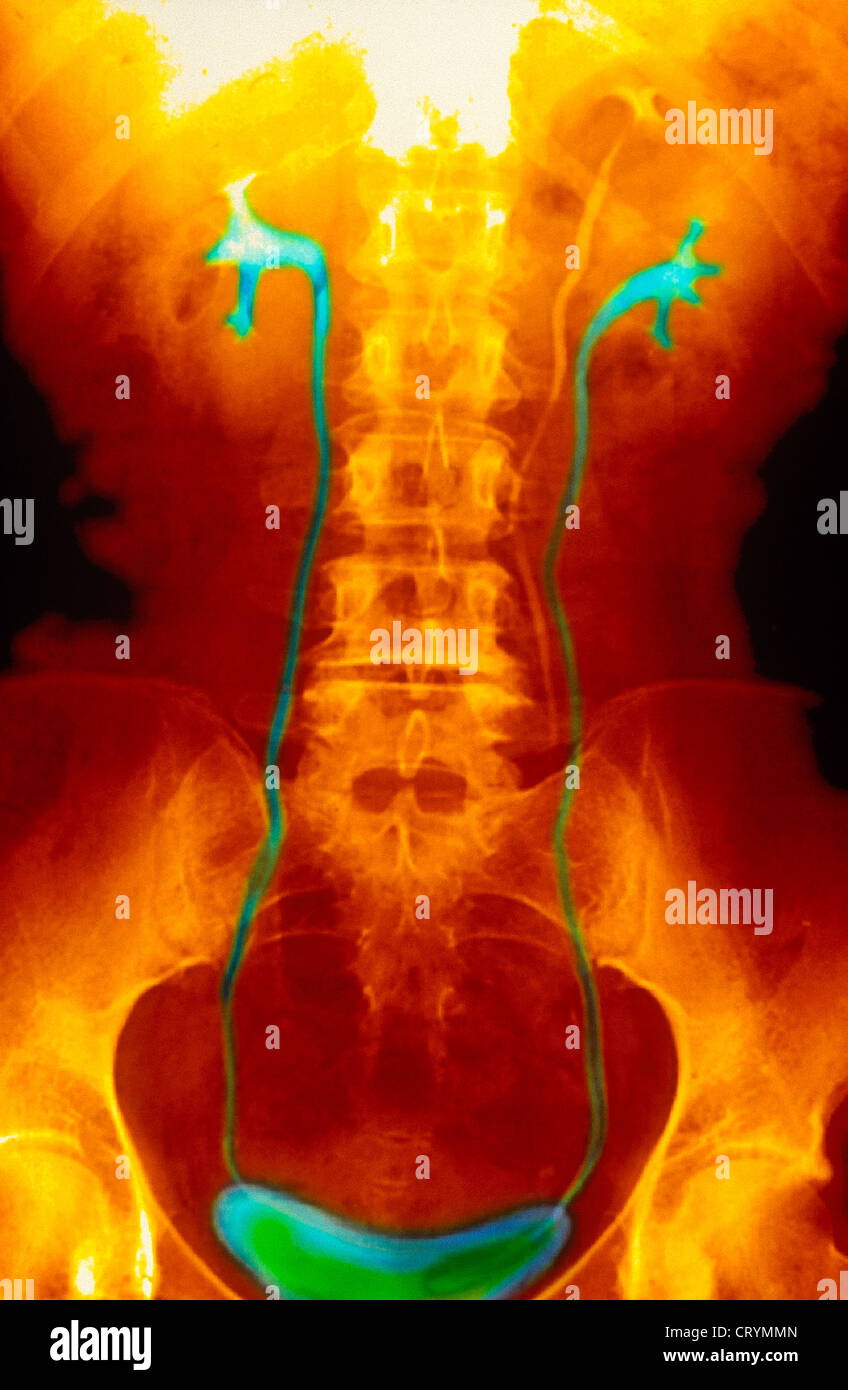 X ray urinary system normal hi-res stock photography and images - Alamy